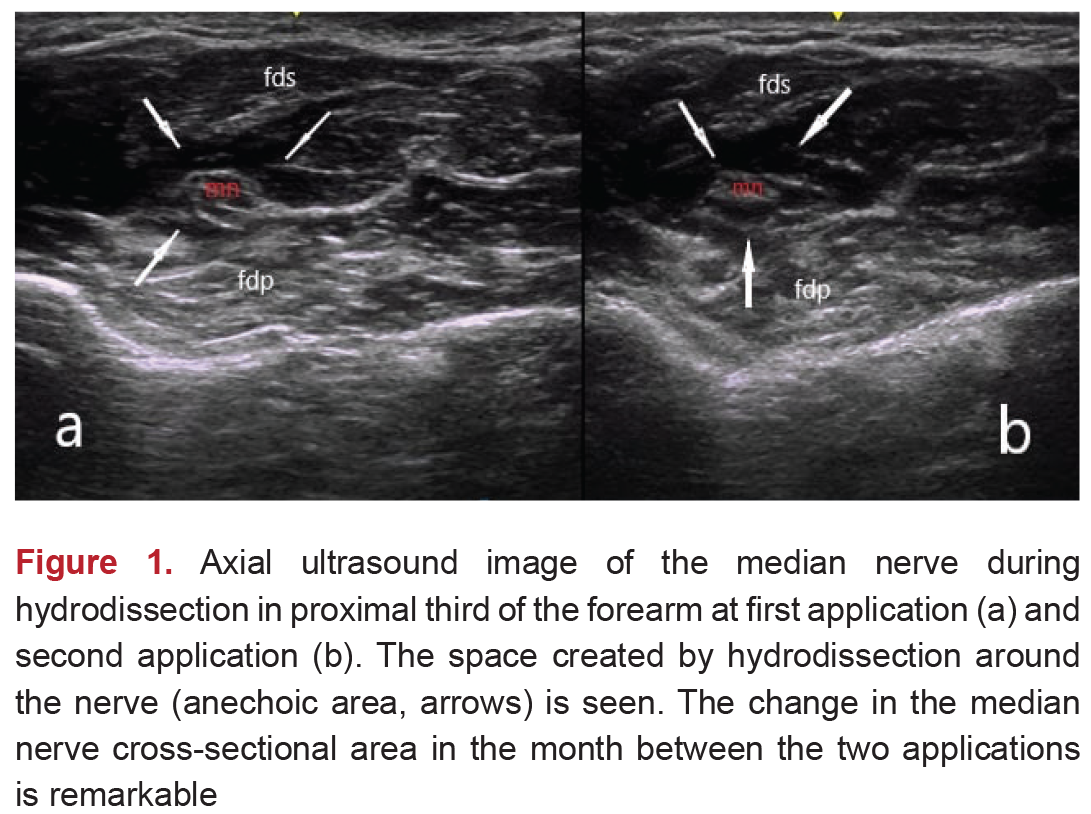 Ultrasound-guided hydrodissection to entrapped median nerve after ...