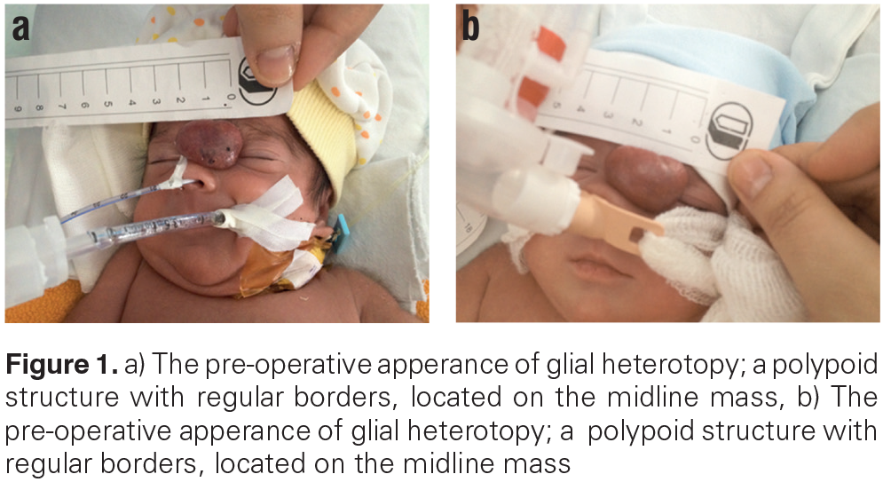 Nasal heterotopy in a Newborn Infant: A Case Report - The Journal of ...