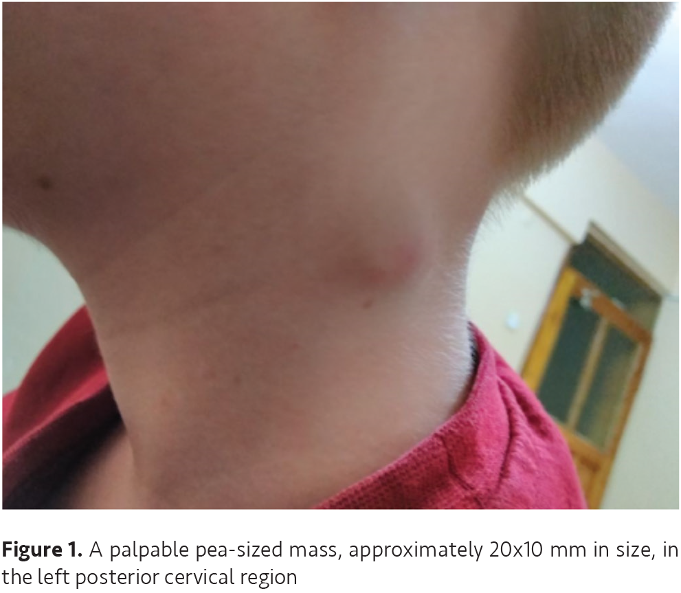 A Rare Cause of Neck Mass: Pilomatrixoma - The Journal of Pediatric ...