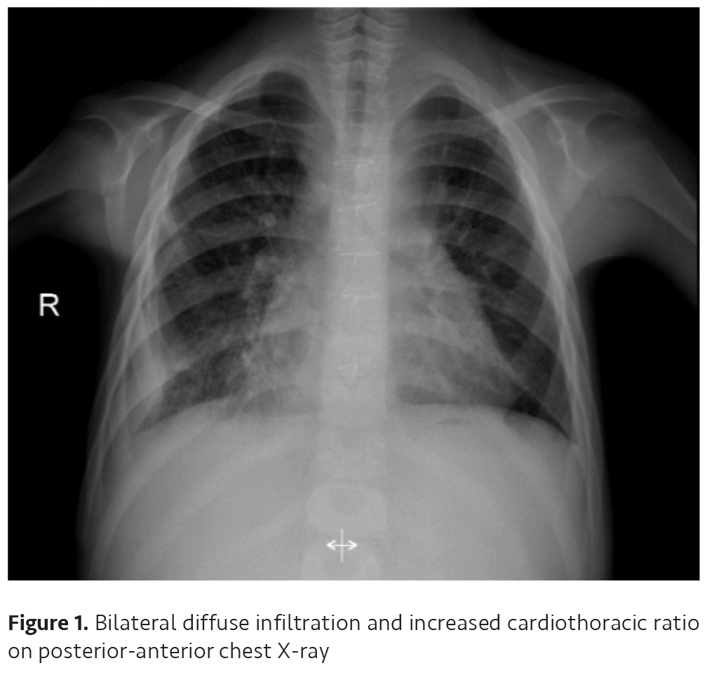 Plastic Bronchitis Following Fontan Procedure: A Case Report - The ...