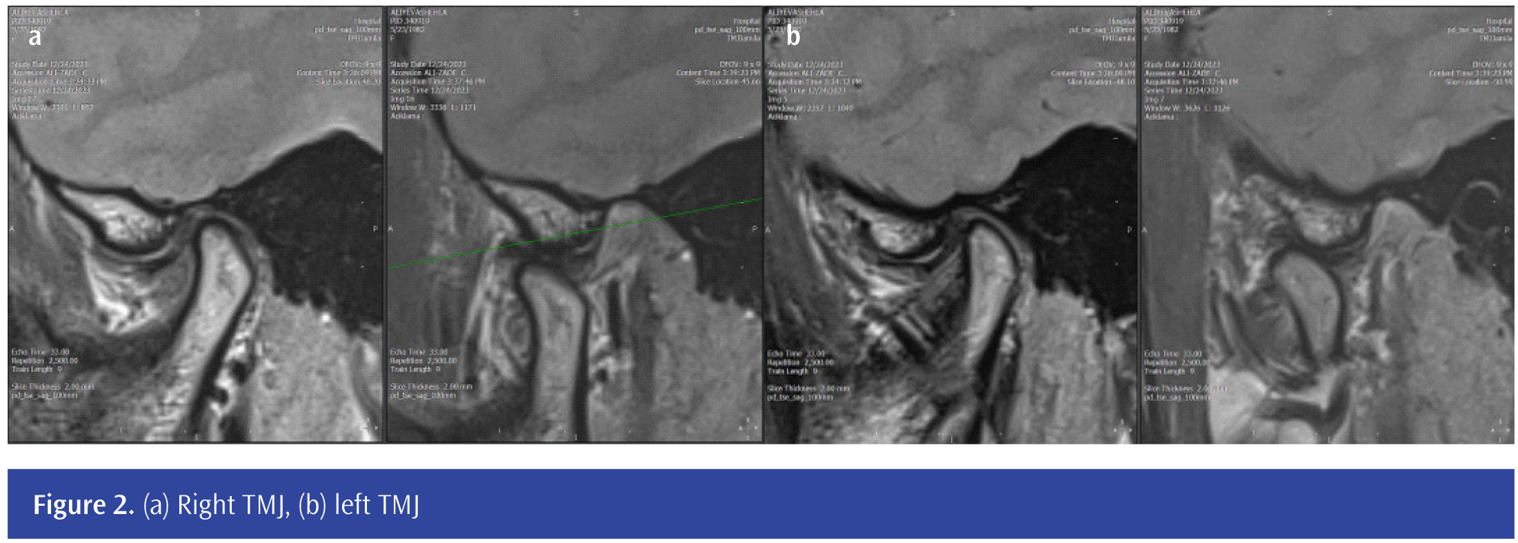 Temporomandibular Joint Internal Derangement: A Case Report and ...