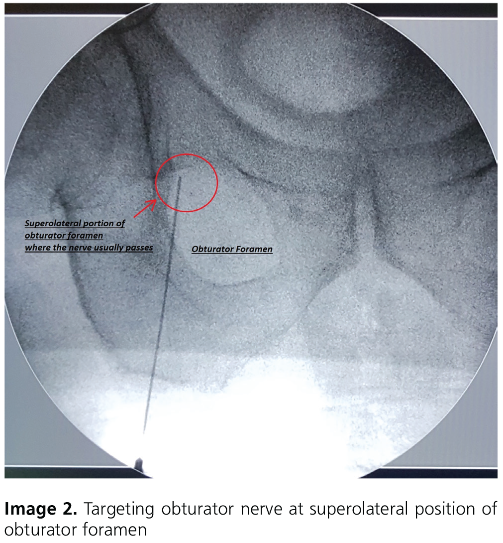 A Different Obturator Nerve Block Approach Using Nerve Stimulation Device Under Fluoroscopy