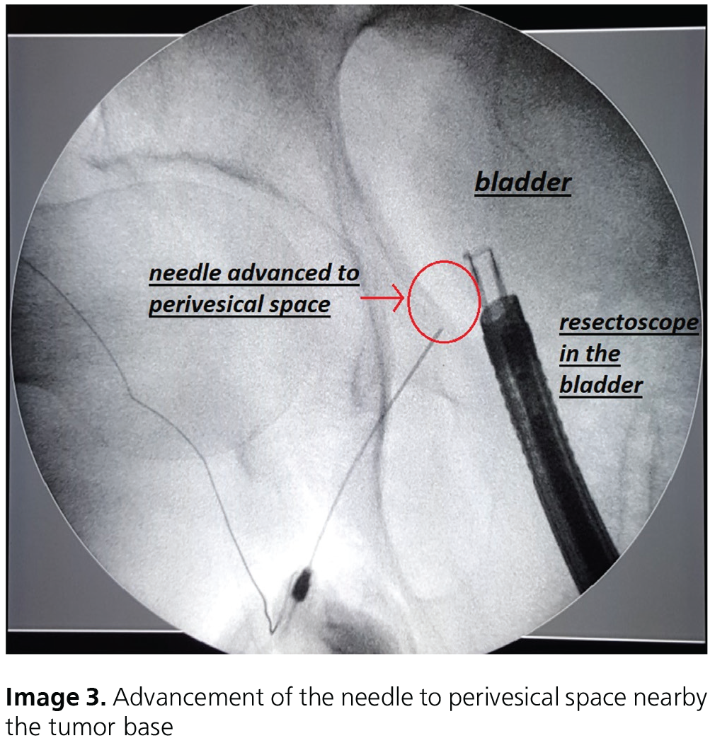 A Different Obturator Nerve Block Approach Using Nerve Stimulation Device Under Fluoroscopy