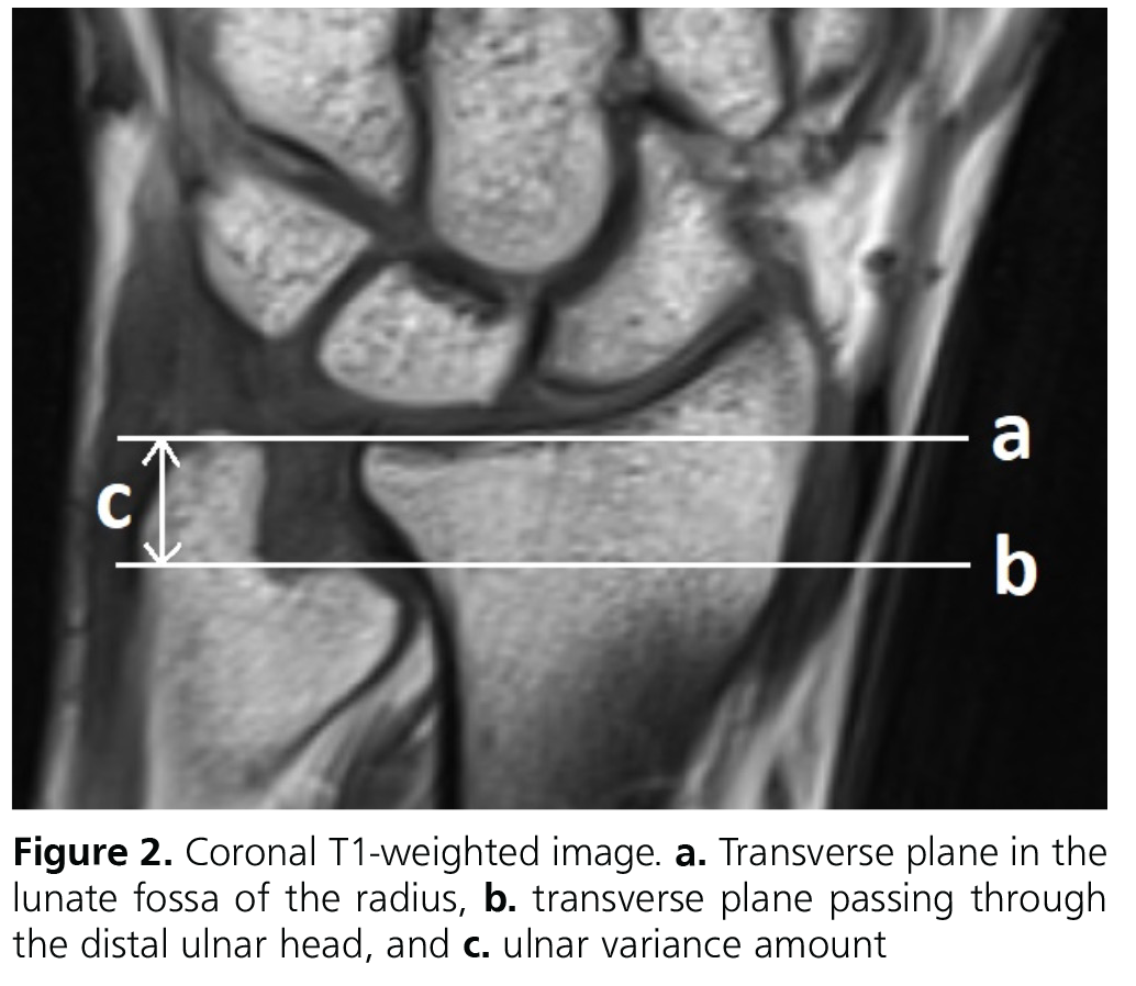 Investigation of the Relationship Between Wrist Ganglion Cysts and the ...