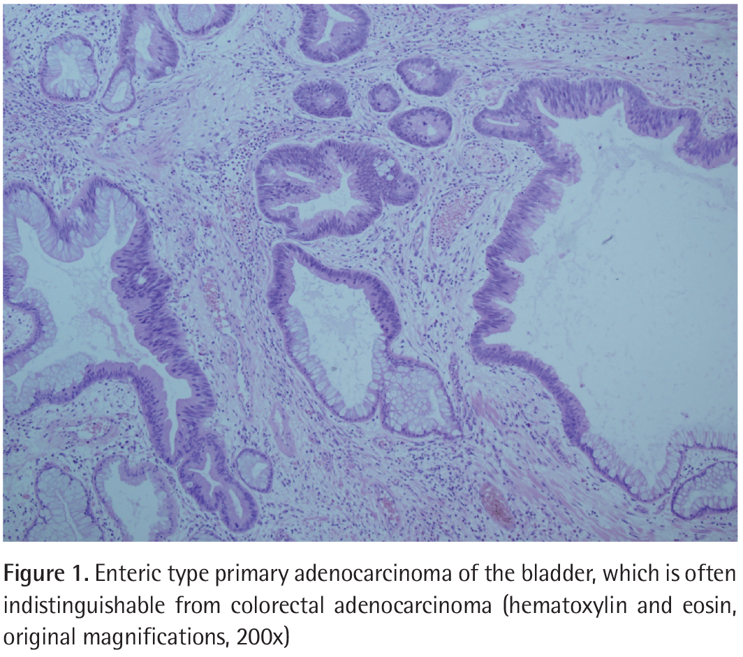 Adenocarcinoma of the Urinary Bladder - Journal of Urological Surgery ...