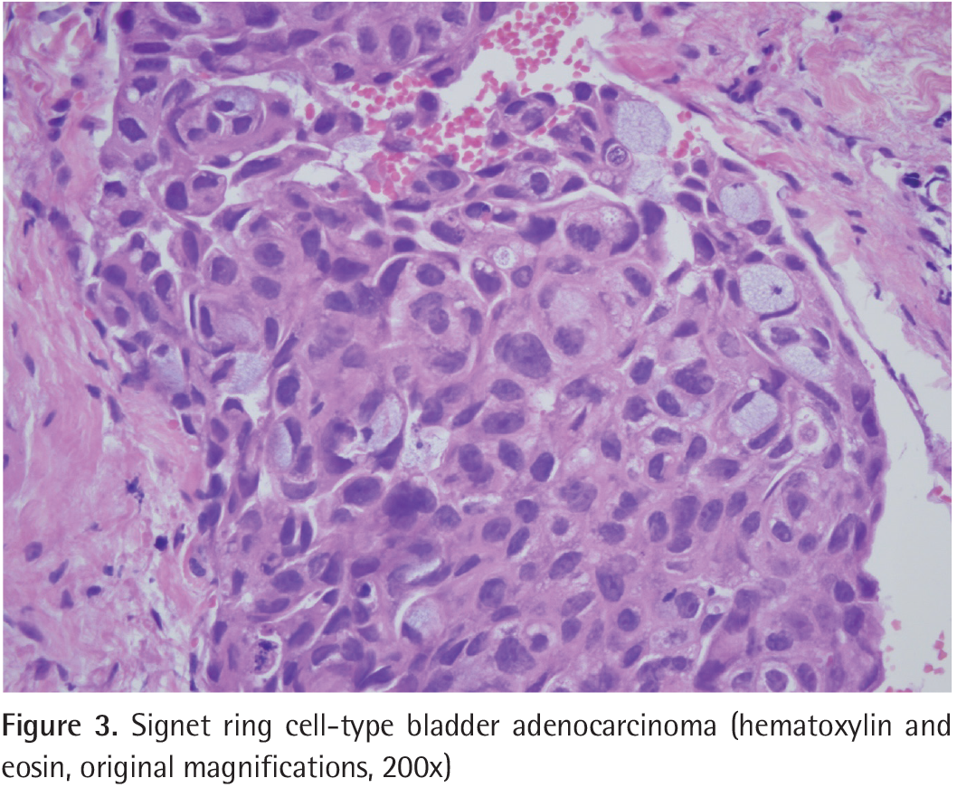 Adenocarcinoma of the Urinary Bladder - Journal of Urological Surgery ...