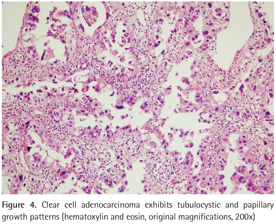 Adenocarcinoma of the Urinary Bladder - Journal of Urological Surgery ...