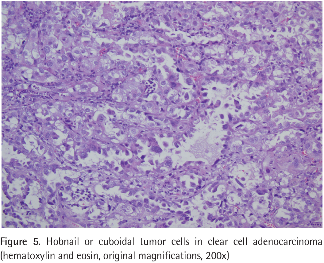 Adenocarcinoma of the Urinary Bladder - Journal of Urological Surgery ...