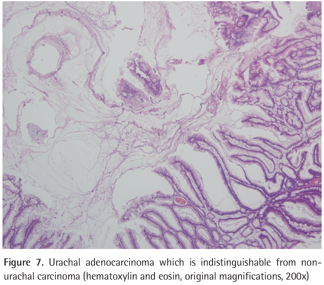 Adenocarcinoma of the Urinary Bladder - Journal of Urological Surgery ...