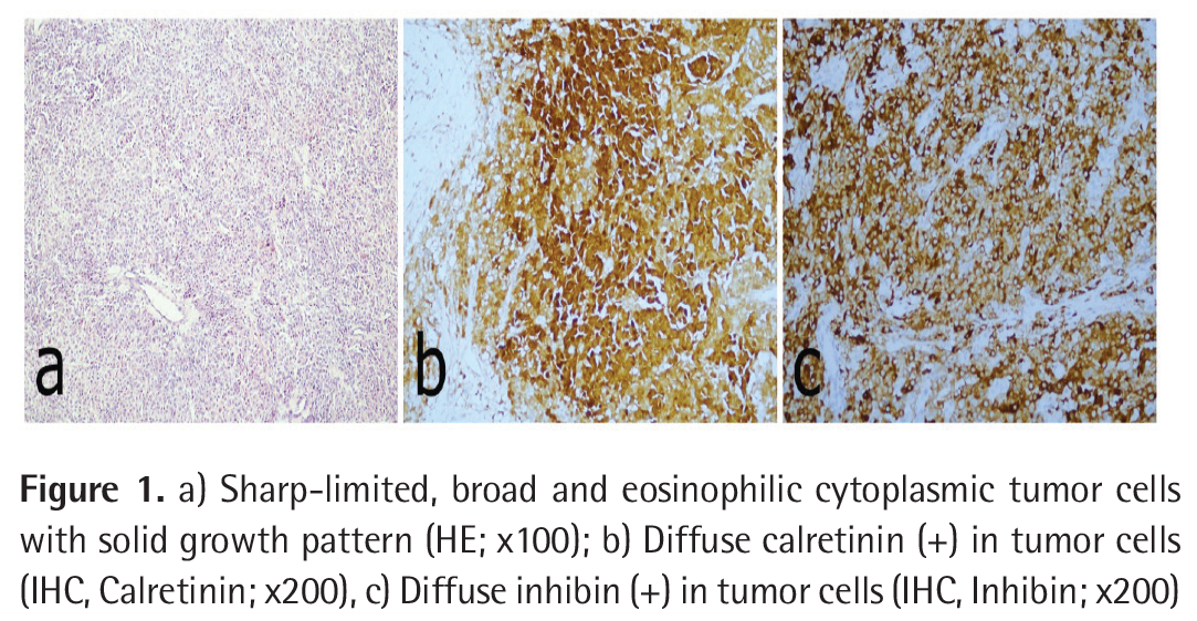Leydig Cell Tumor Of The Testis A Case With Incidental Diagnosis