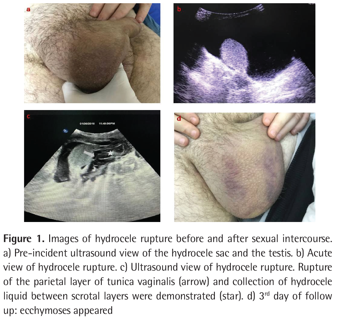 Hydrocele Rupture during Sexual Intercourse: a Case Report and Review ...