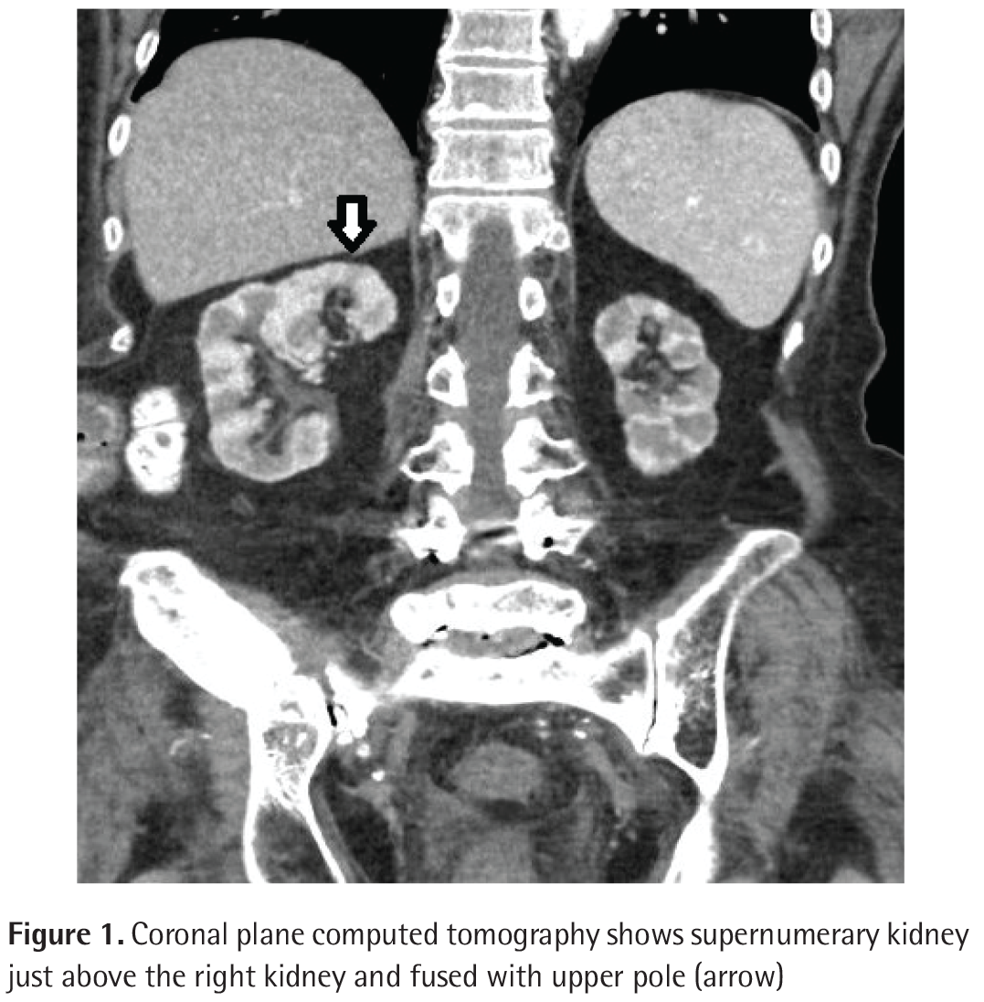 A Rare Case of Incidentally Detected Fused Supernumerary Kidney ...