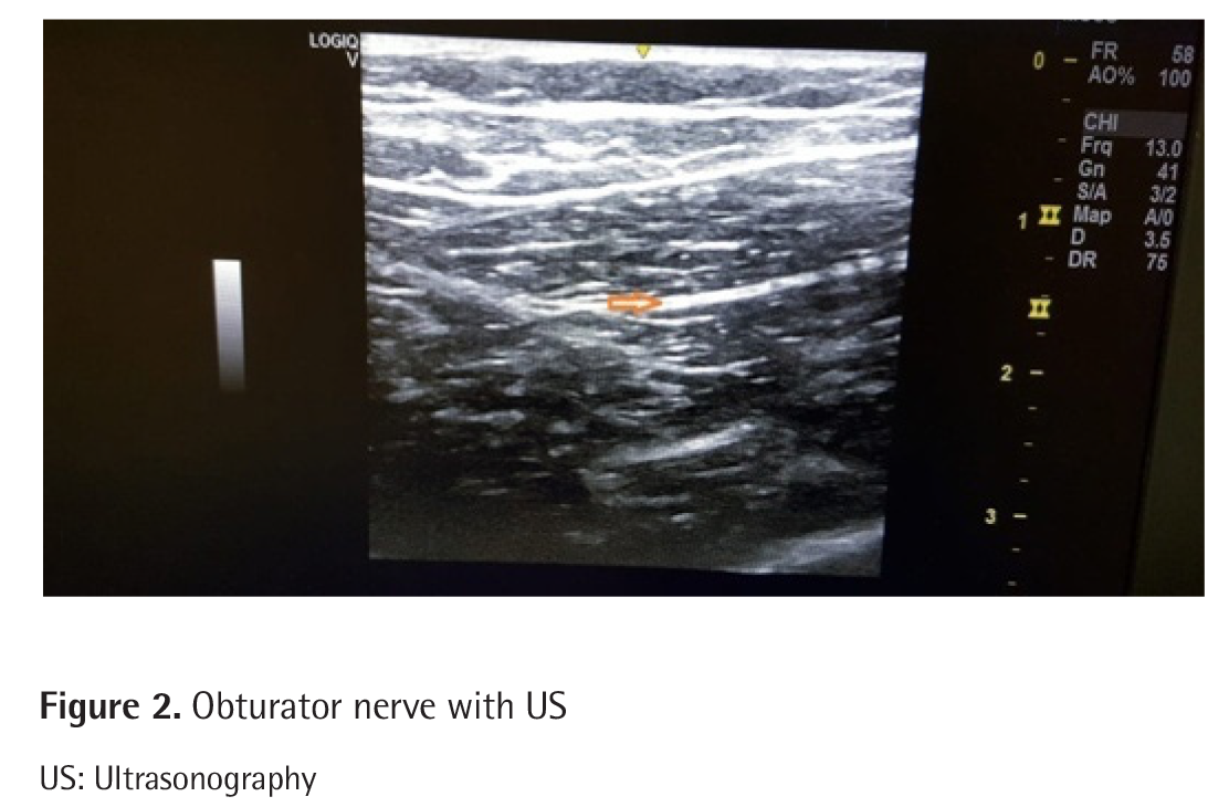 Effect Of Ultrasound Guided Obturator Nerve Block On Complications In Transurethral Resection