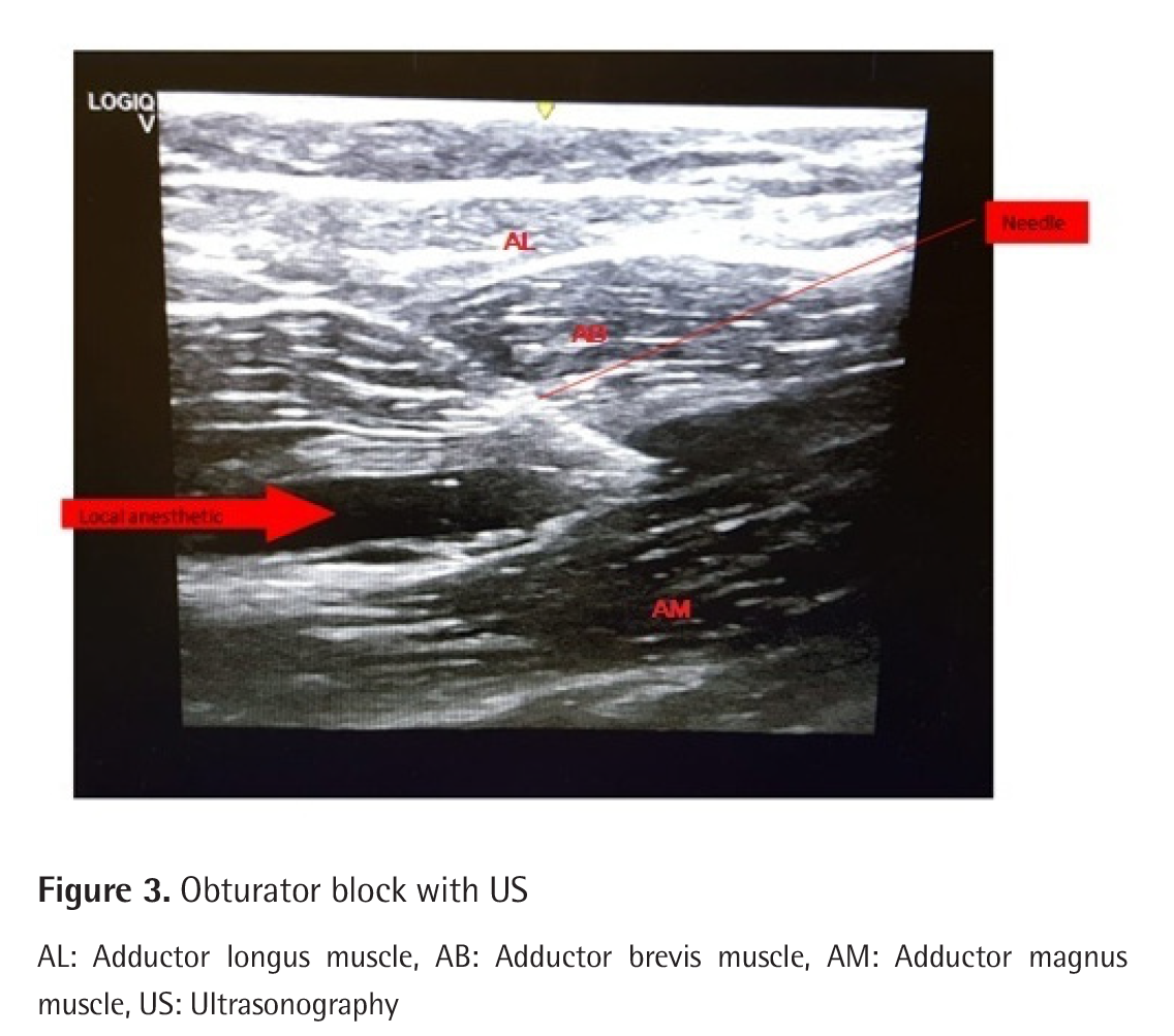 Effect Of Ultrasound Guided Obturator Nerve Block On Complications In Transurethral Resection