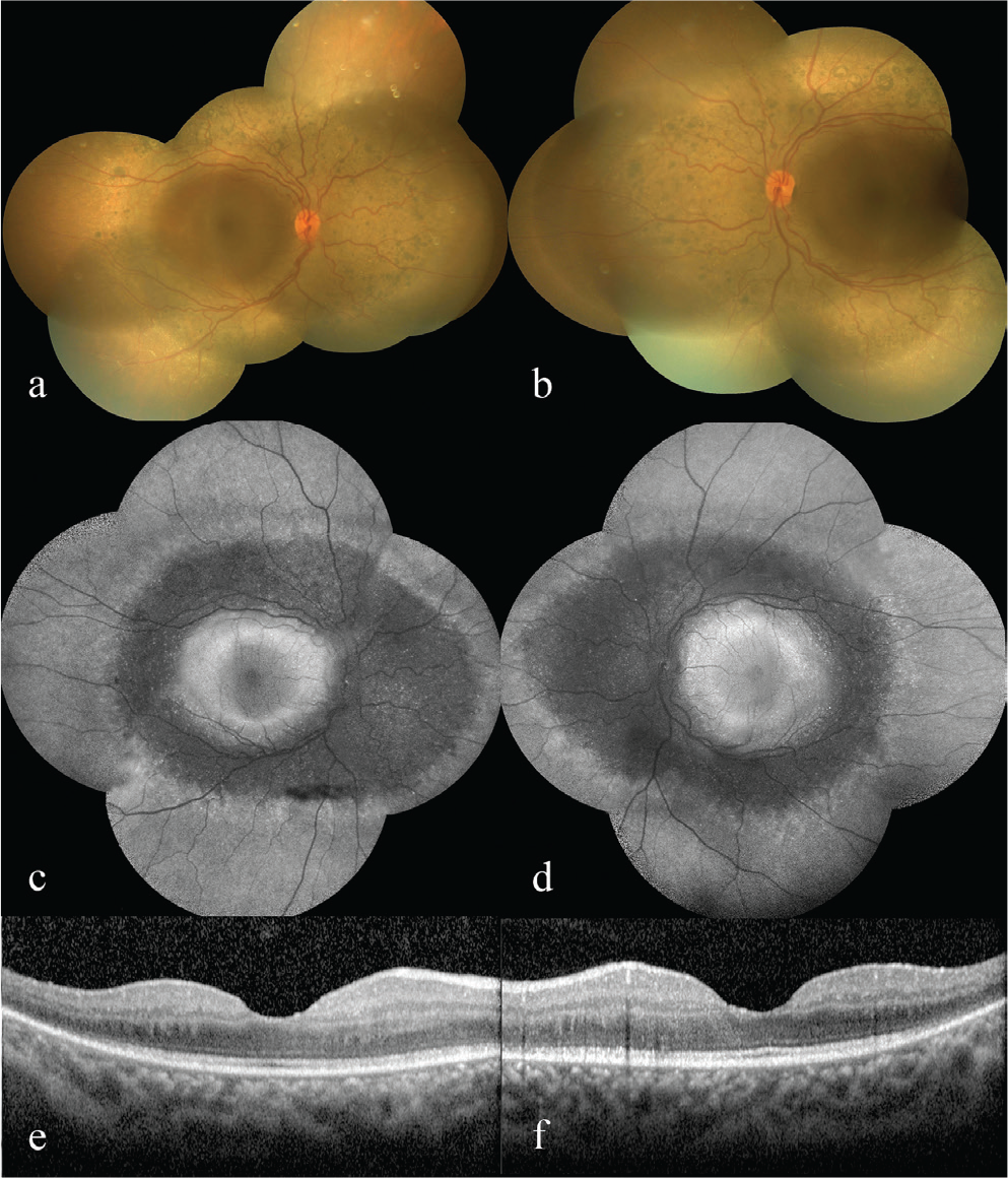 Goldmann-Favre Syndrome: Case Series - Turkish Journal of Ophthalmology ...