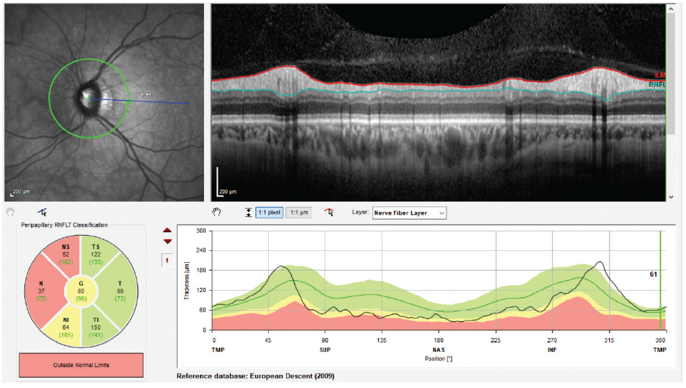 Artifacts and Anatomic Variations in Optical Coherence Tomography ...