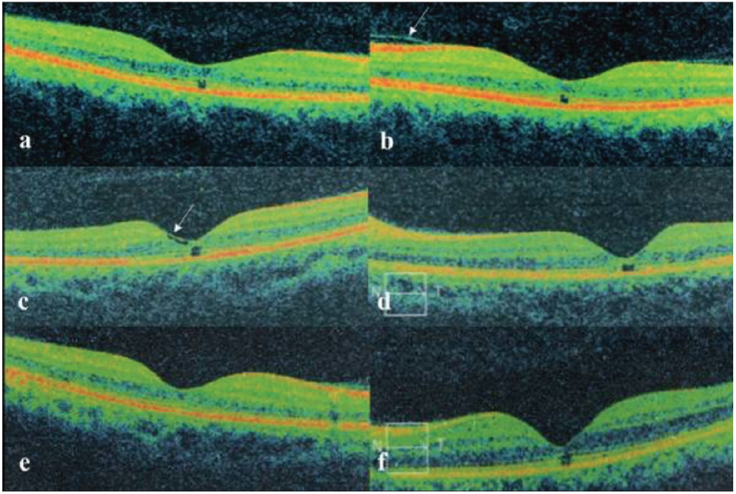 Solar Retinopathy Presenting with Outer Retinal Defects Among Habitants ...