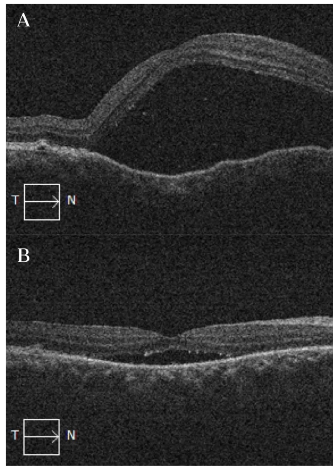 Filtering Pseudo-Bleb Secondary to Sutured Posterior Chamber ...