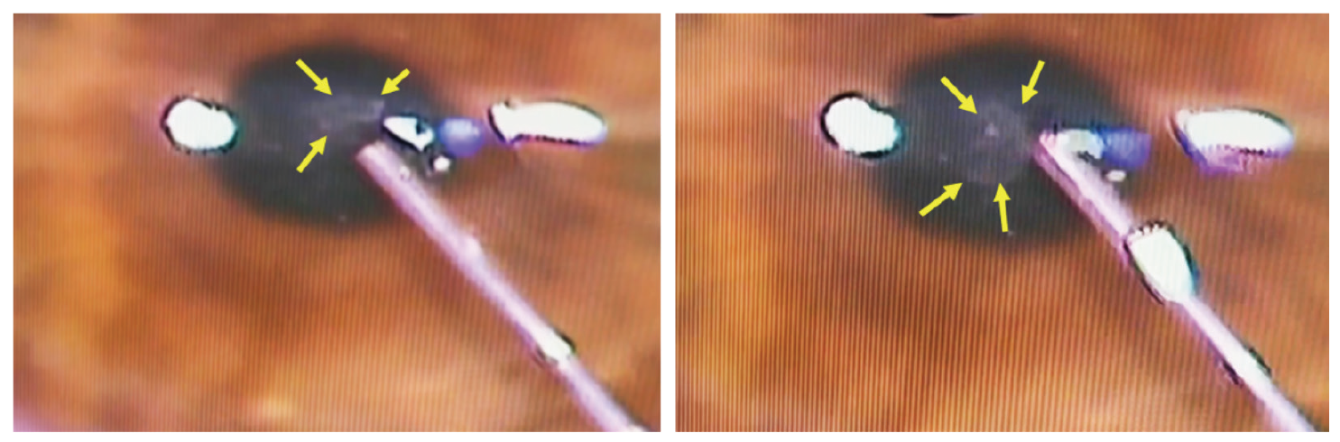 Epithelial Inoculation After Small-Incision Lenticule Extraction (SMILE ...