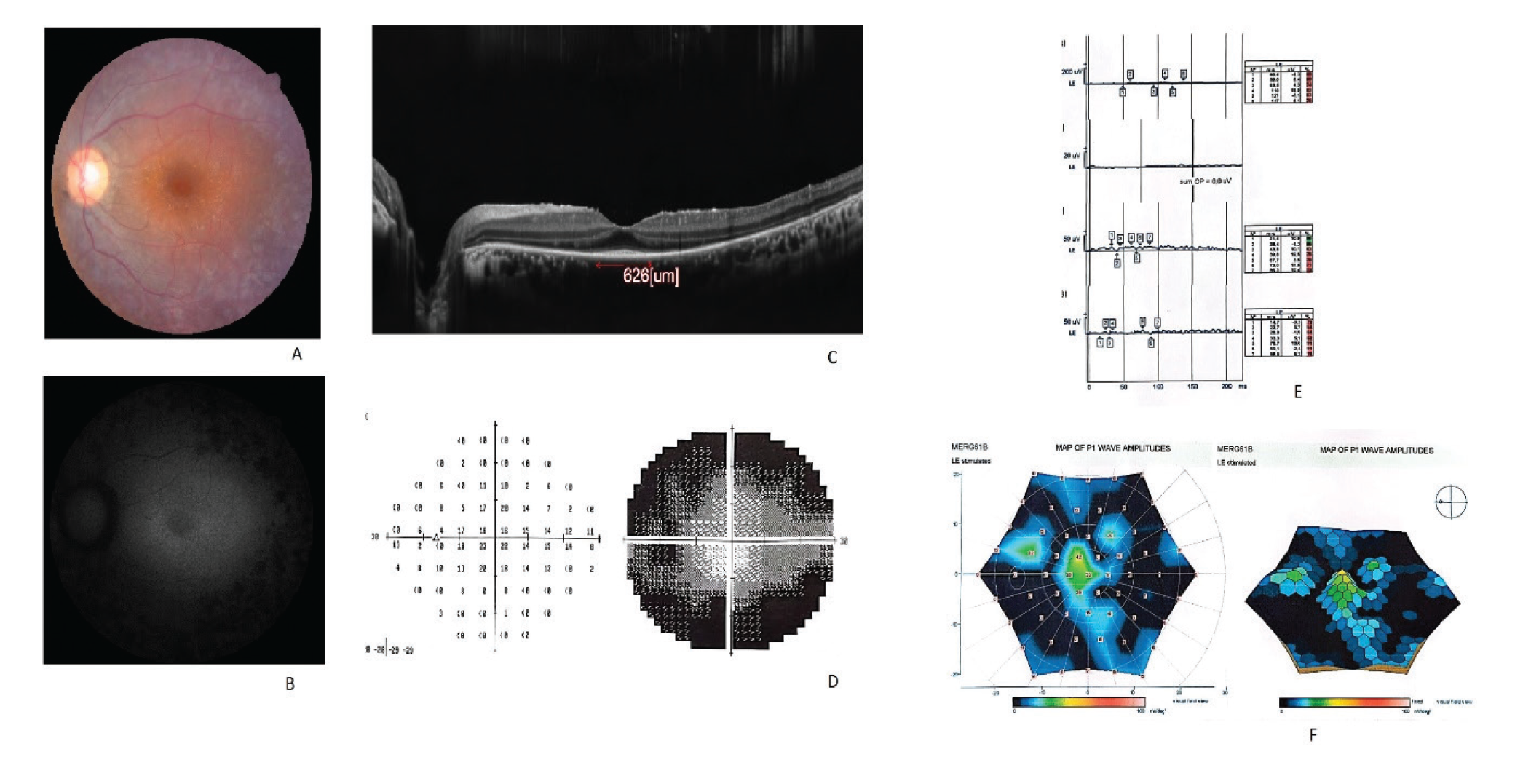Evaluation of Full-Field Stimulus Threshold Test Results in Retinitis ...