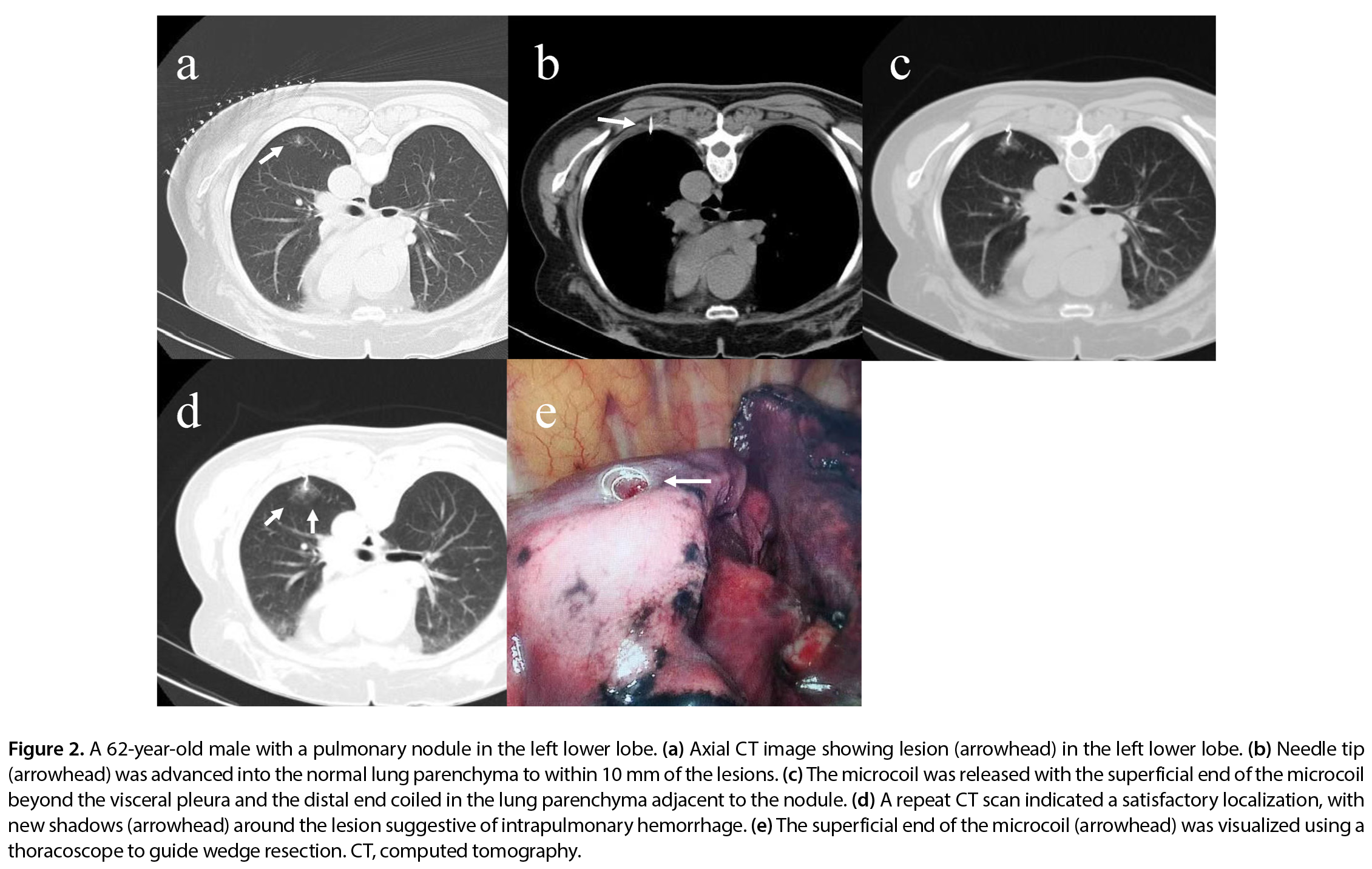 CT-guided microcoil localization for scapula-blocked pulmonary nodules ...