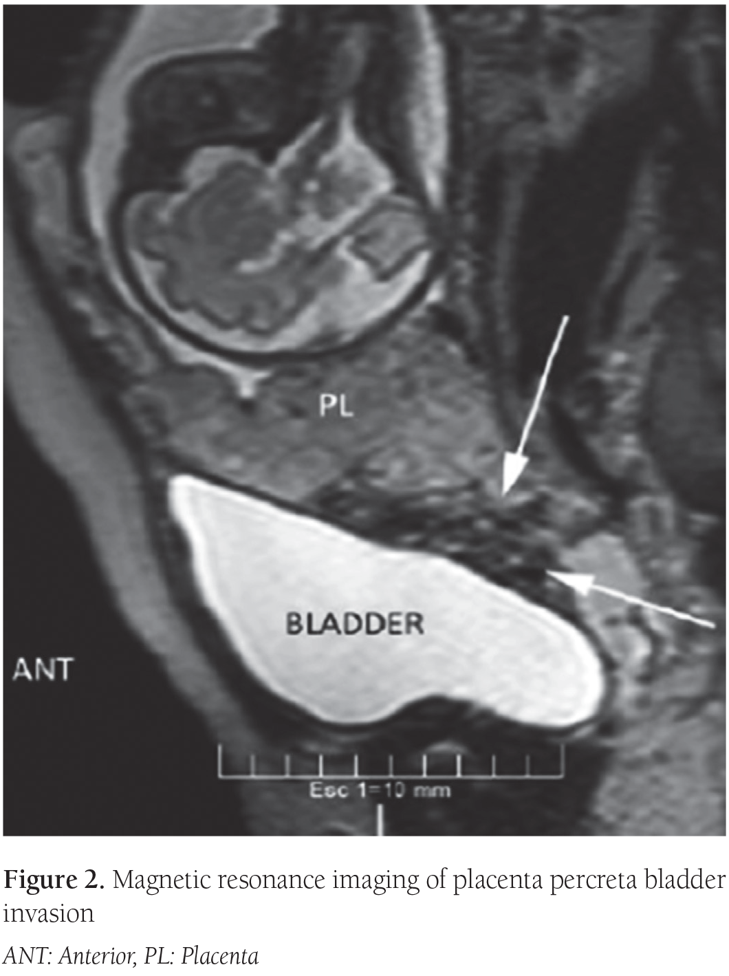 External iliac artery thrombosis after hypogastric artery ligation and ...