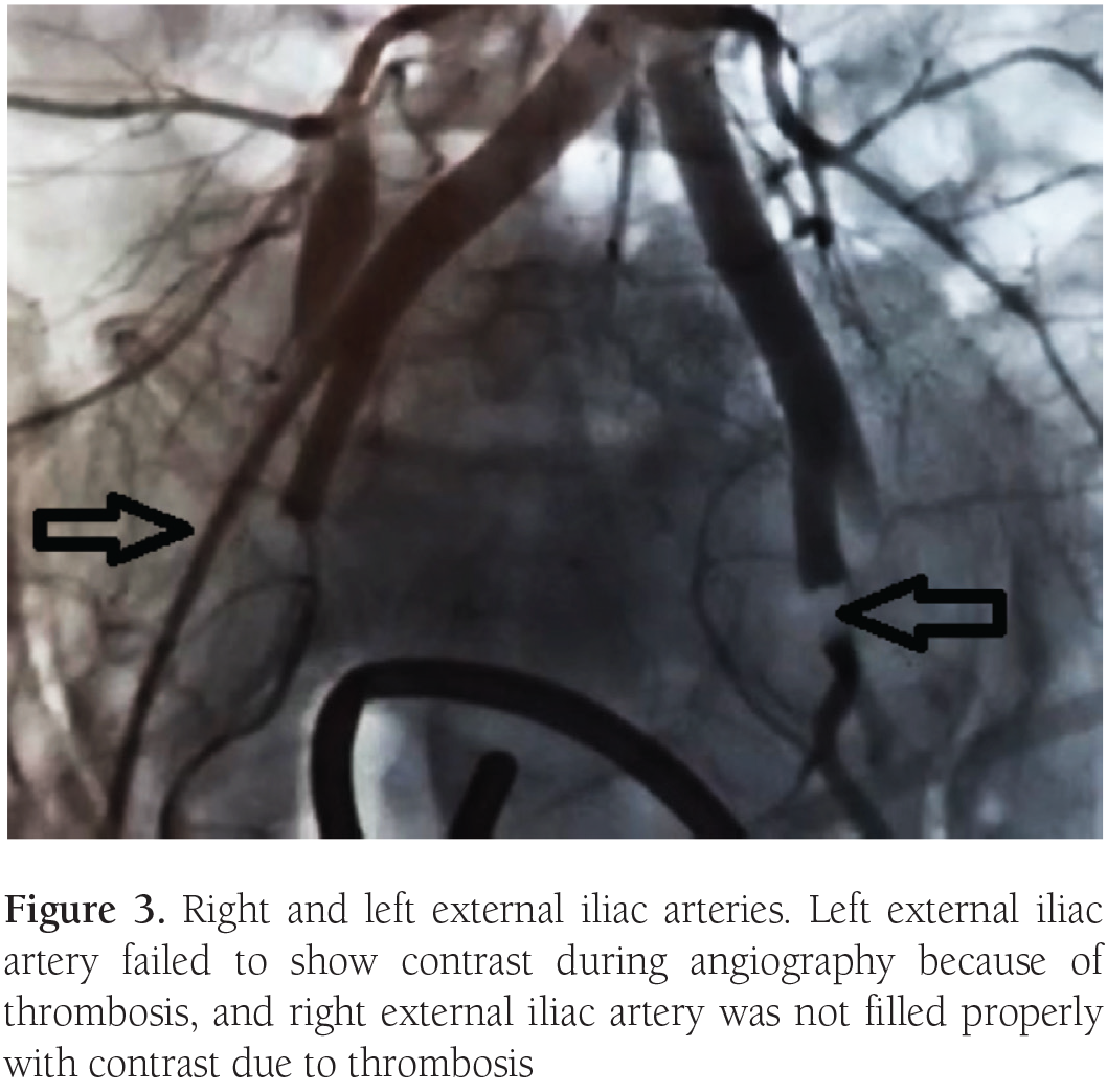 External iliac artery thrombosis after hypogastric artery ligation and ...