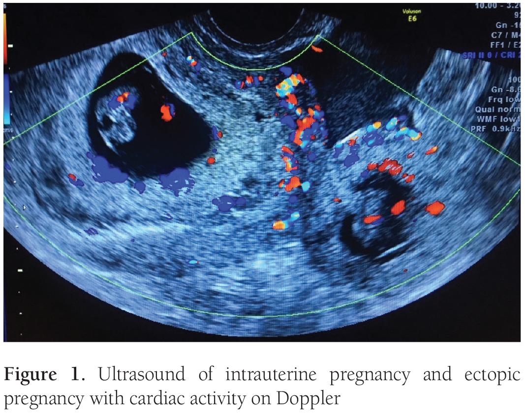 A spontaneous heterotopic pregnancy presenting with acute abdomen ...