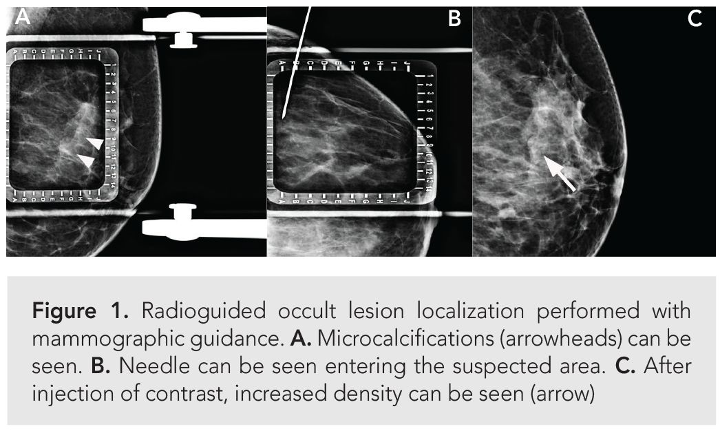 Radioguided Occult Lesion Localization Versus Wireguided Localization ...