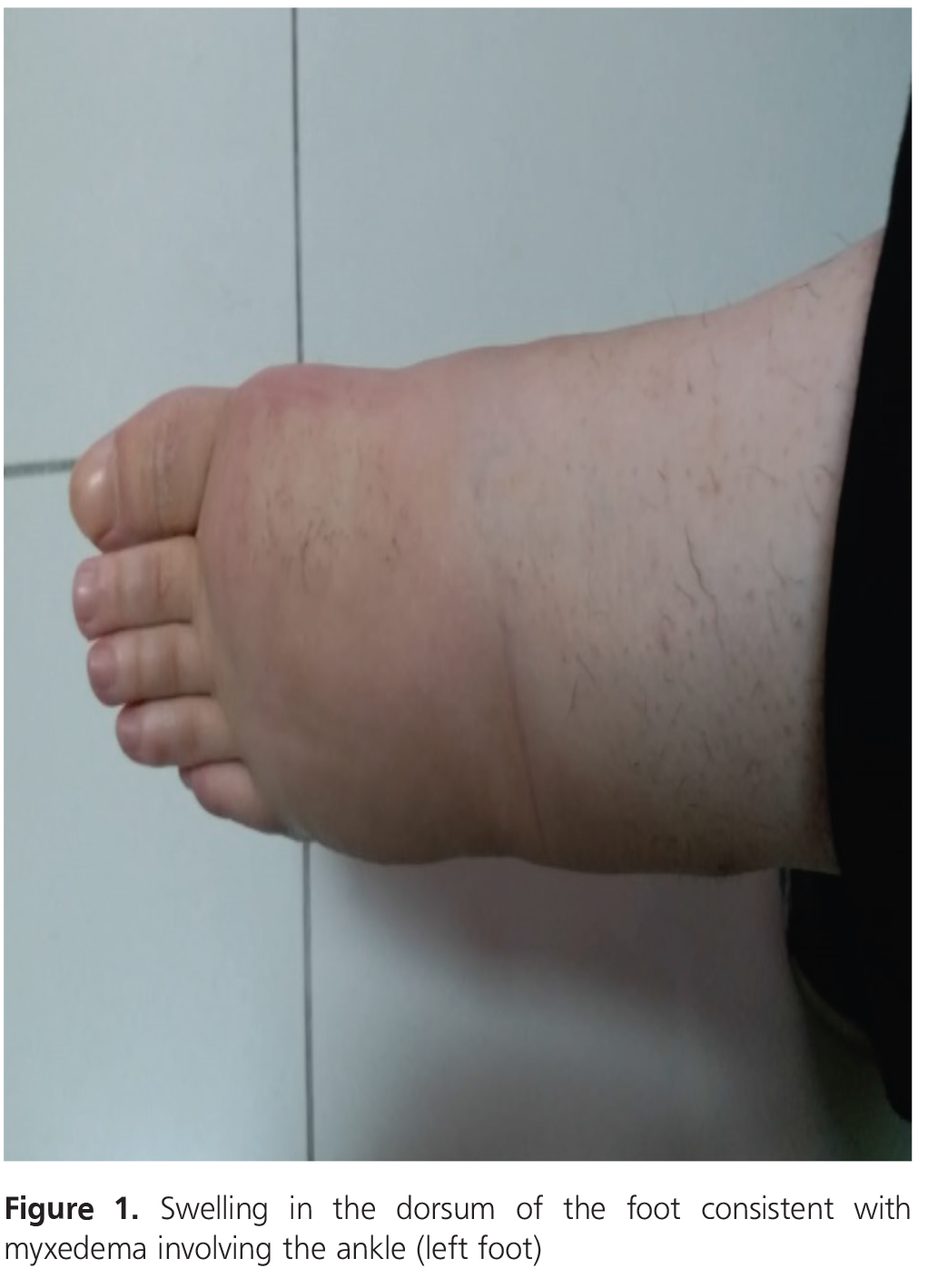 Differential Diagnosis of Thyroid Dermopathy and Acropachy with ...