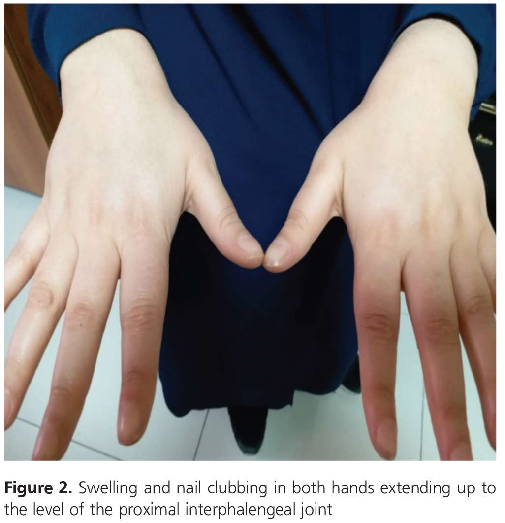 Differential Diagnosis of Thyroid Dermopathy and Acropachy with ...