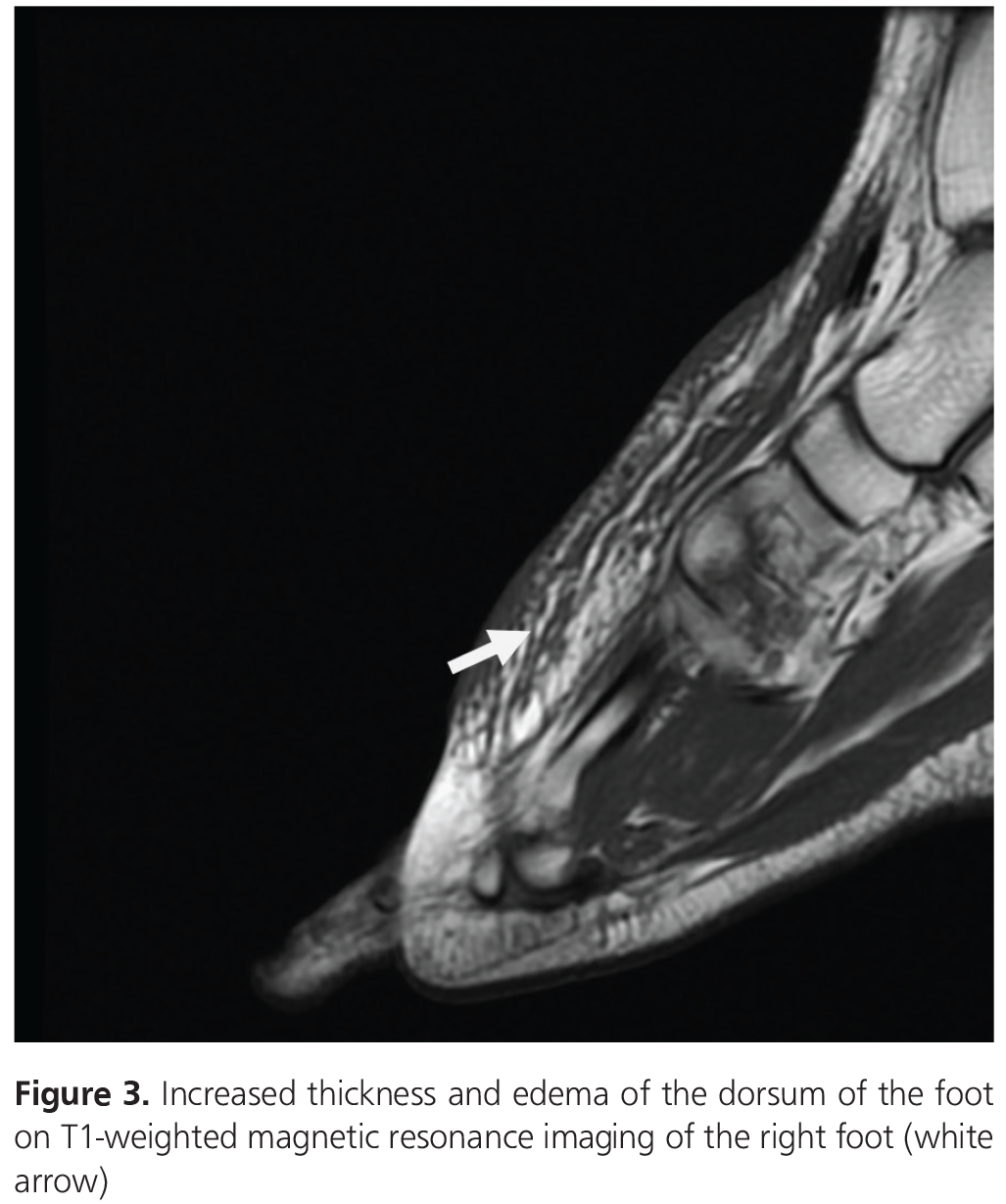 Differential Diagnosis of Thyroid Dermopathy and Acropachy with ...