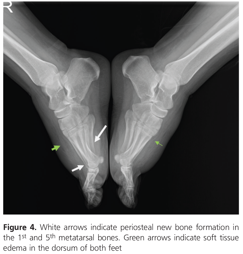 Differential Diagnosis of Thyroid Dermopathy and Acropachy with ...
