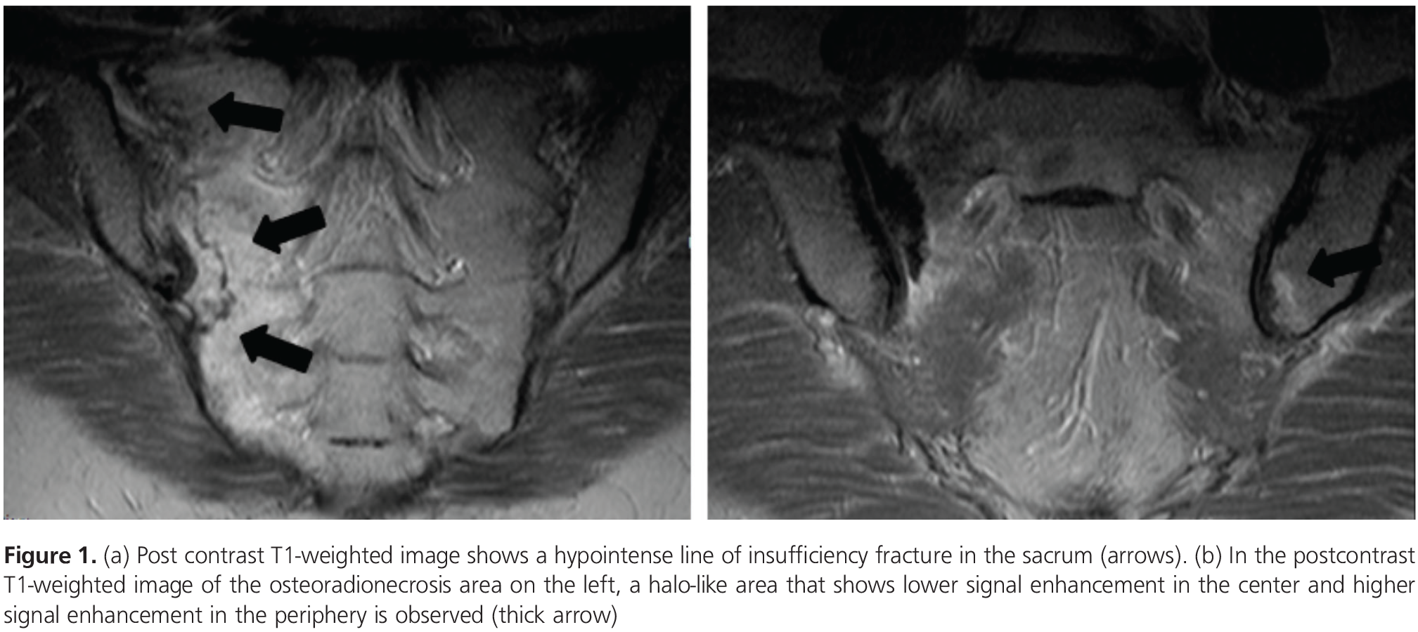 Osteonecrosis of the Iliac Wing and Sacral Insufficiency Fractures ...