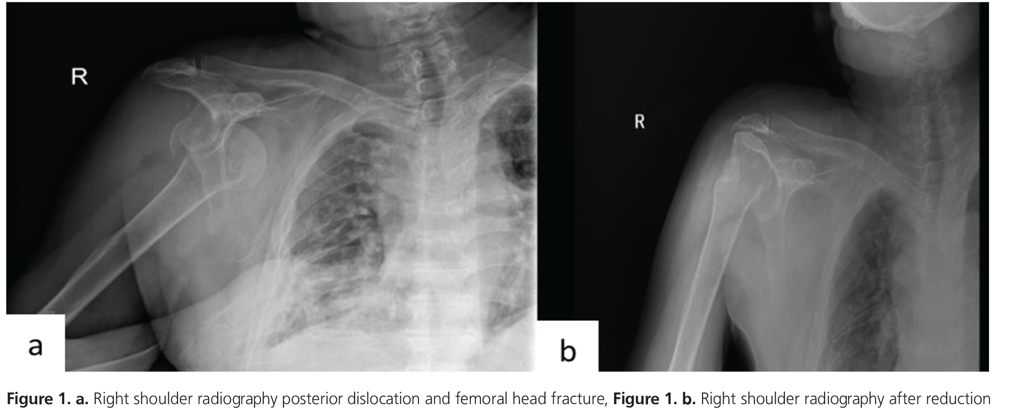 Post-stroke Complication of Shoulder Dislocation and Fracture of the ...