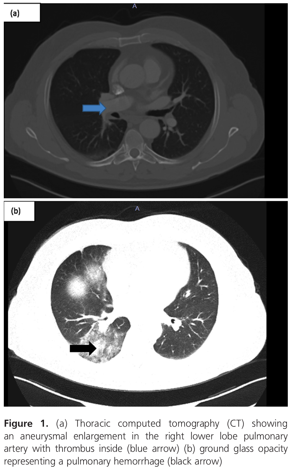 Patient Presenting with Hemoptysis: A Case of Hughes-Stovin Syndrome ...