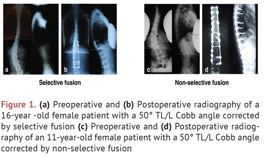 LENKE 5 CURVES: IS THORACIC FUSION REALLY NECESSARY? - The Journal of ...