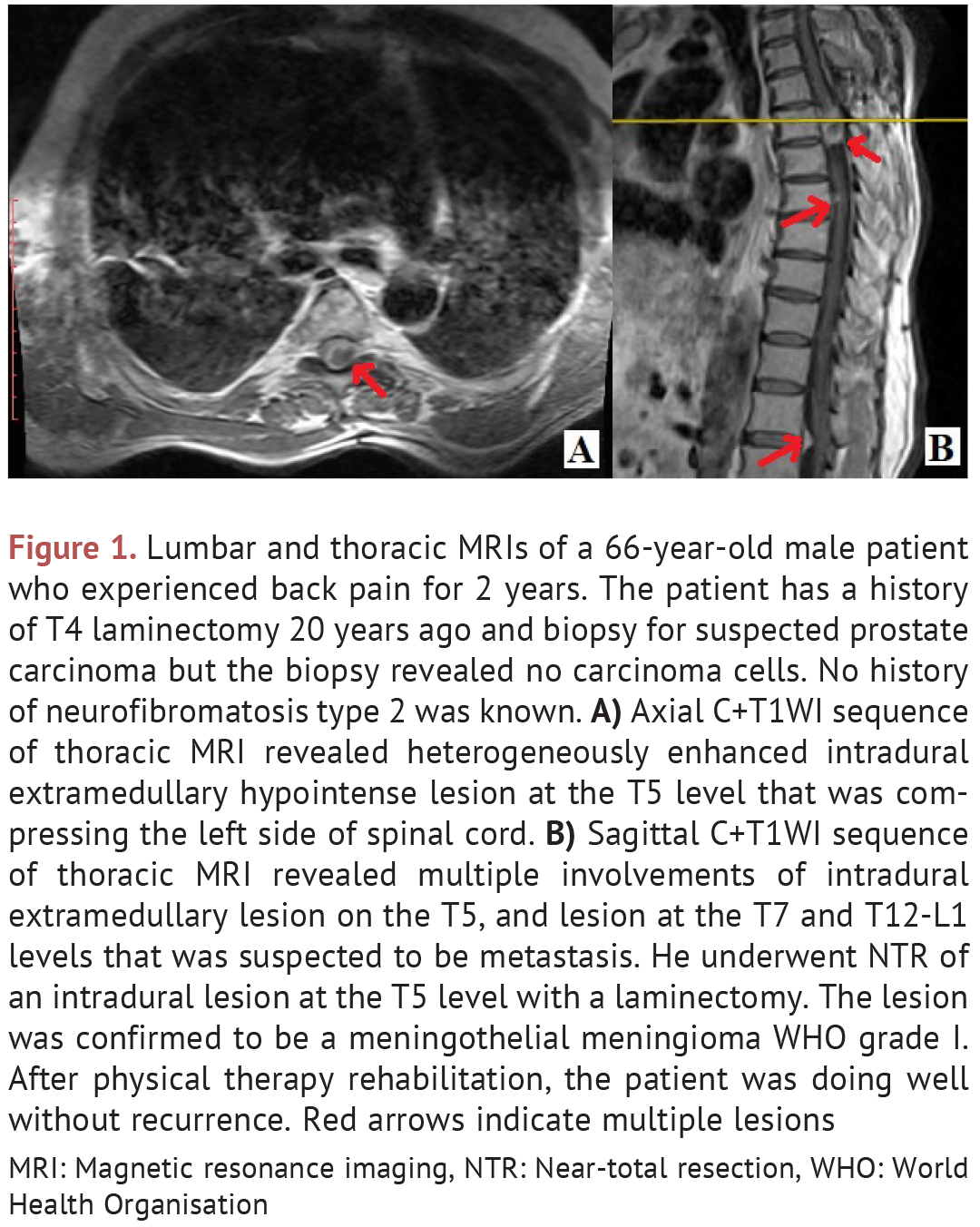 MANAGEMENT AND SURGICAL OUTCOMES OF ADULT SPINAL INTRADURAL LESIONS: A ...