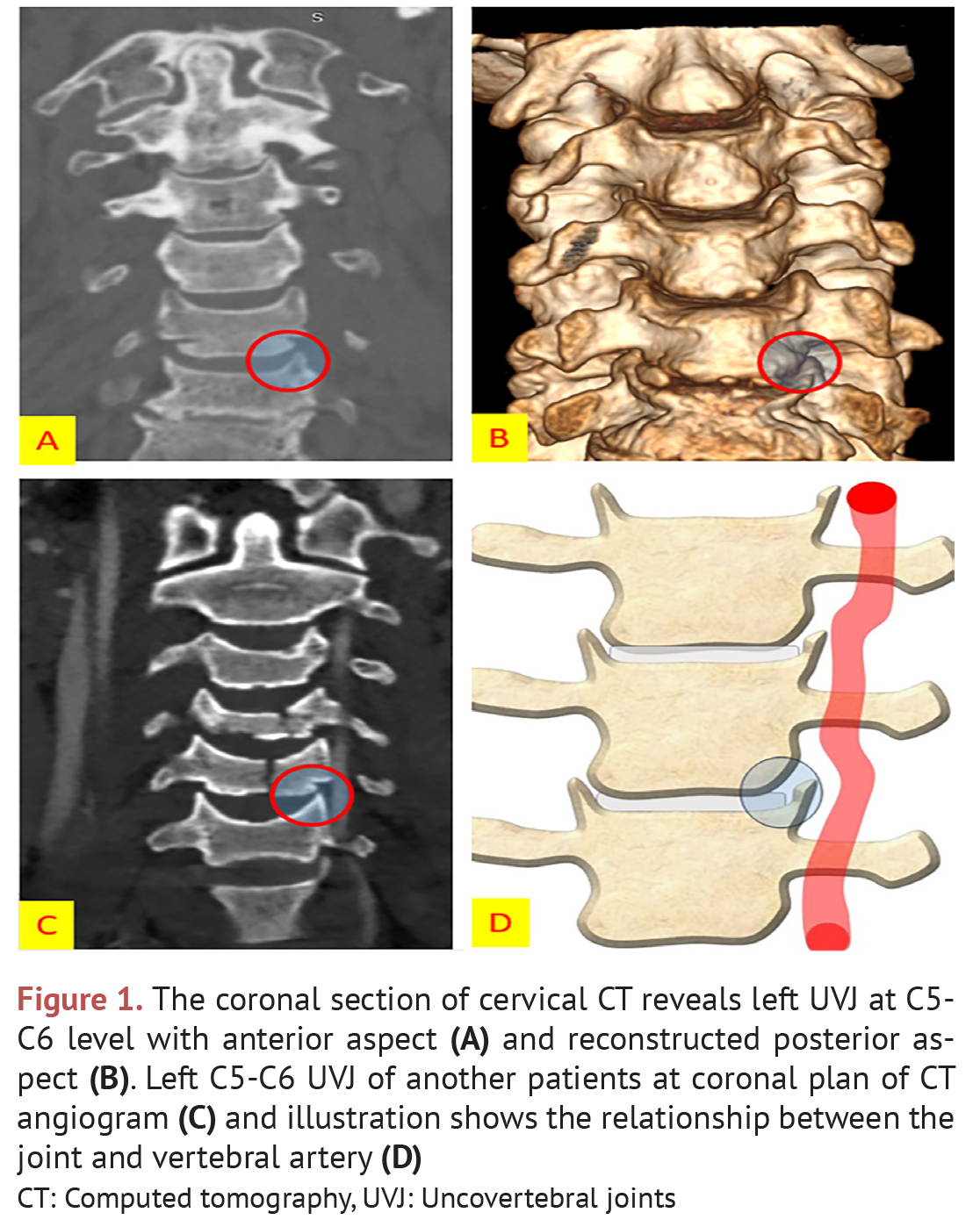 MANAGEMENT OF SUBAXIAL CERVICAL SPINE FRACTURES WITH ANTERIOR CERVICAL ...