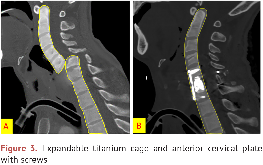 MANAGEMENT OF SUBAXIAL CERVICAL SPINE FRACTURES WITH ANTERIOR CERVICAL ...