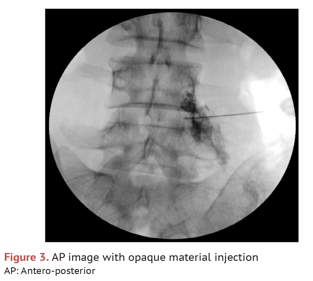 COMPARISON OF SUBPEDICULAR AND KAMBIN’S TRIANGLE APPROACHES IN ...