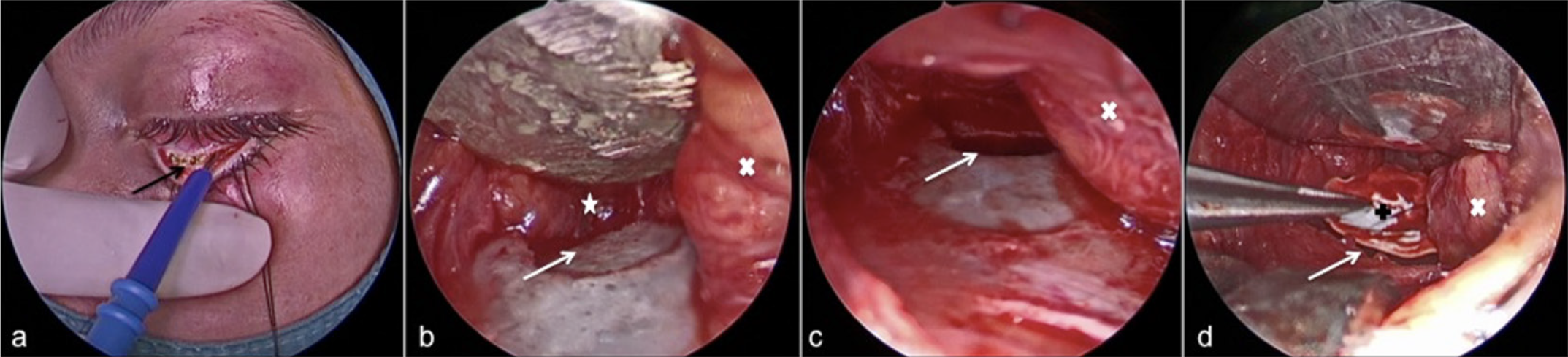 Transconjunctival Endoscopic Repair of a Trapdoor Blowout Fracture in a ...