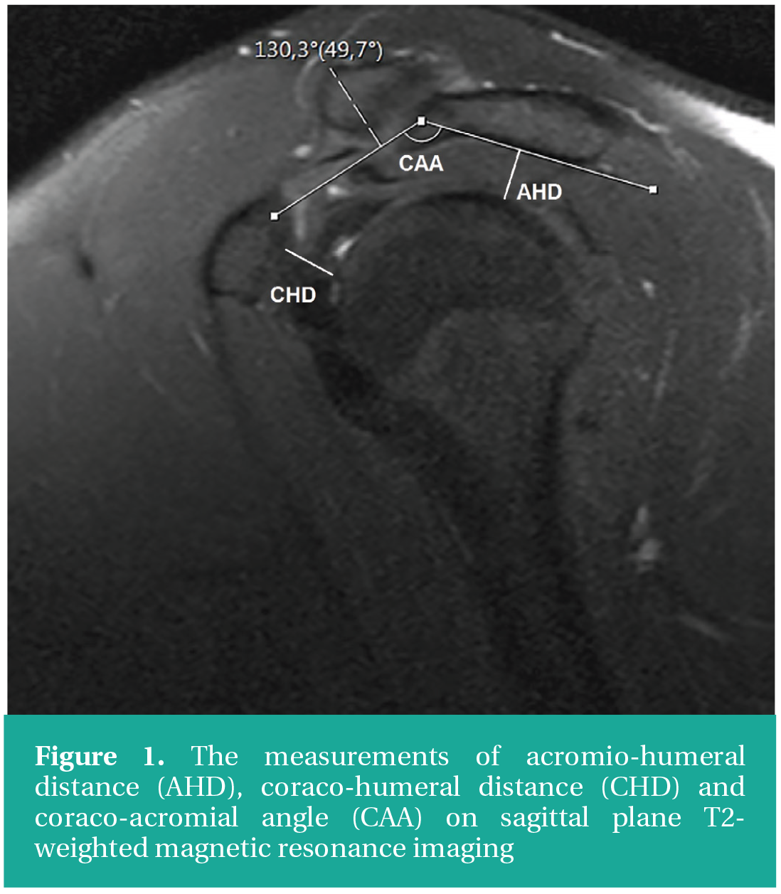 Acromion Types Mri