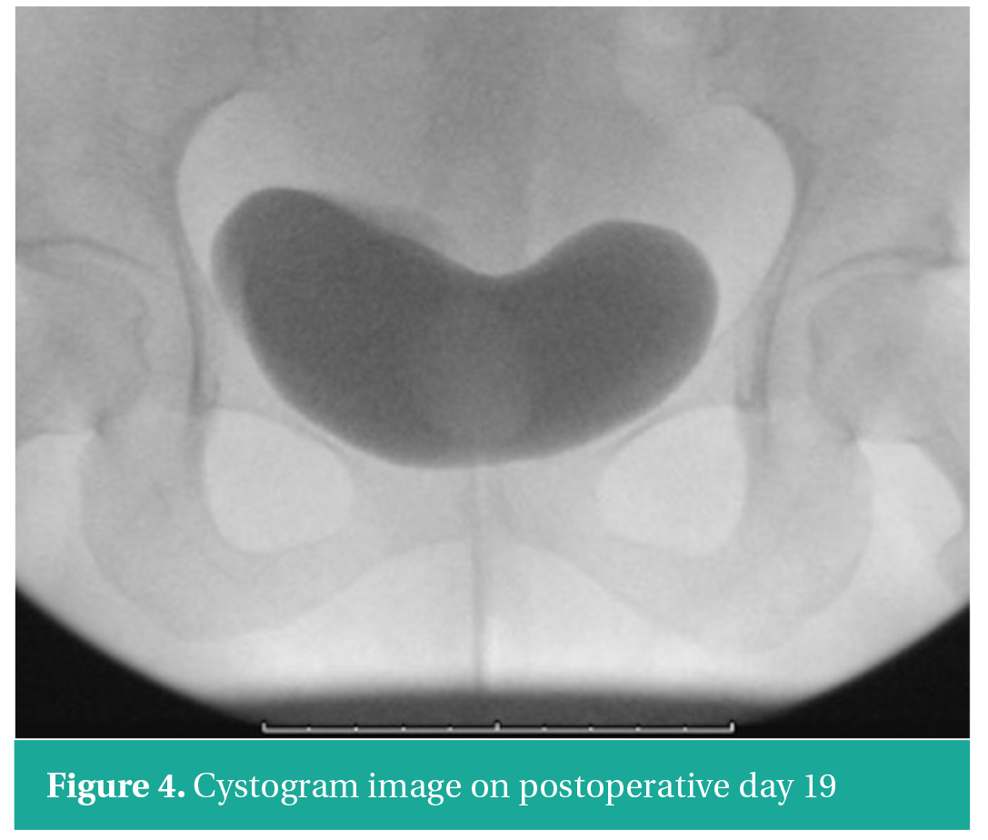 Late Diagnosis of Bladder Injury During Cesarean Section - Bagcilar ...