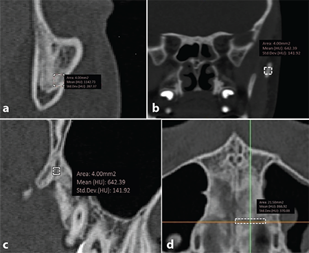 Relationship Between Circummaxillary and Intramaxillary Suture ...