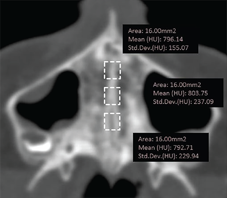 Relationship Between Circummaxillary and Intramaxillary Suture ...