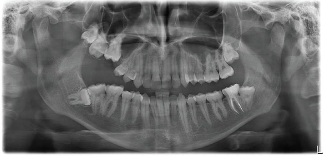 Primary Failure of Eruption: A Rare but Desperate Condition for ...