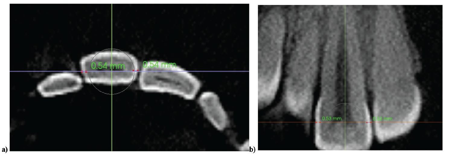 3-Dimensional Evaluation of Enamel Thickness to Guide Orthodontic ...