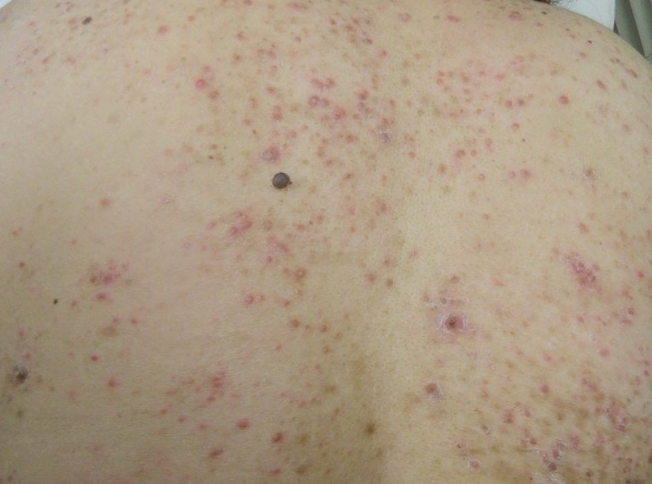 Differential Diagnosis of Mycosis Fungoides: A Review of Literature ...