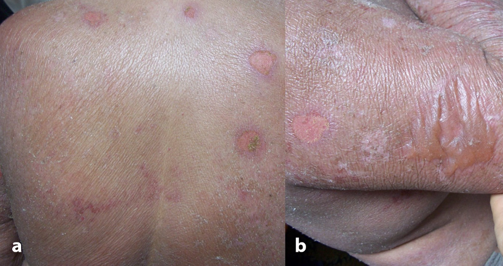 Differential Diagnosis of Mycosis Fungoides: A Review of Literature ...